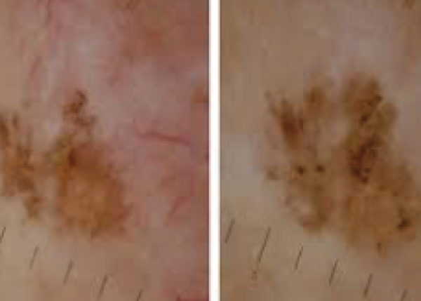 What to look for – Australian Melanoma Research Foundation