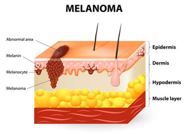 What is melanoma – Australian Melanoma Research Foundation